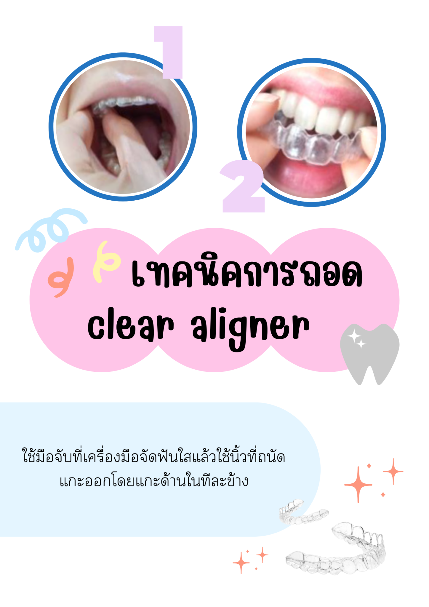 วิธีการใส่ถอด CA - Hippus Clear Aligner